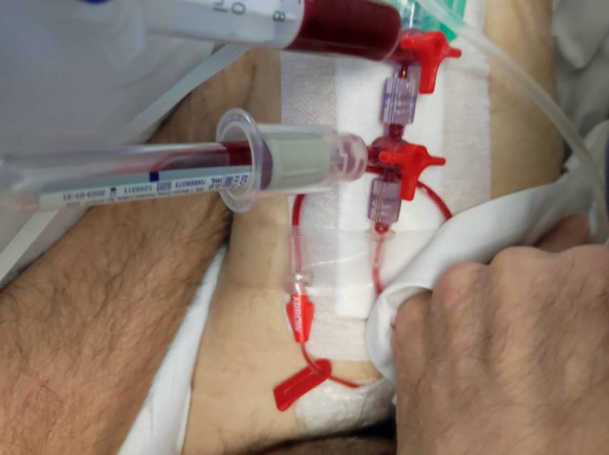 Catéter radial Best Practice: 10 tips imprescindibles para su ...